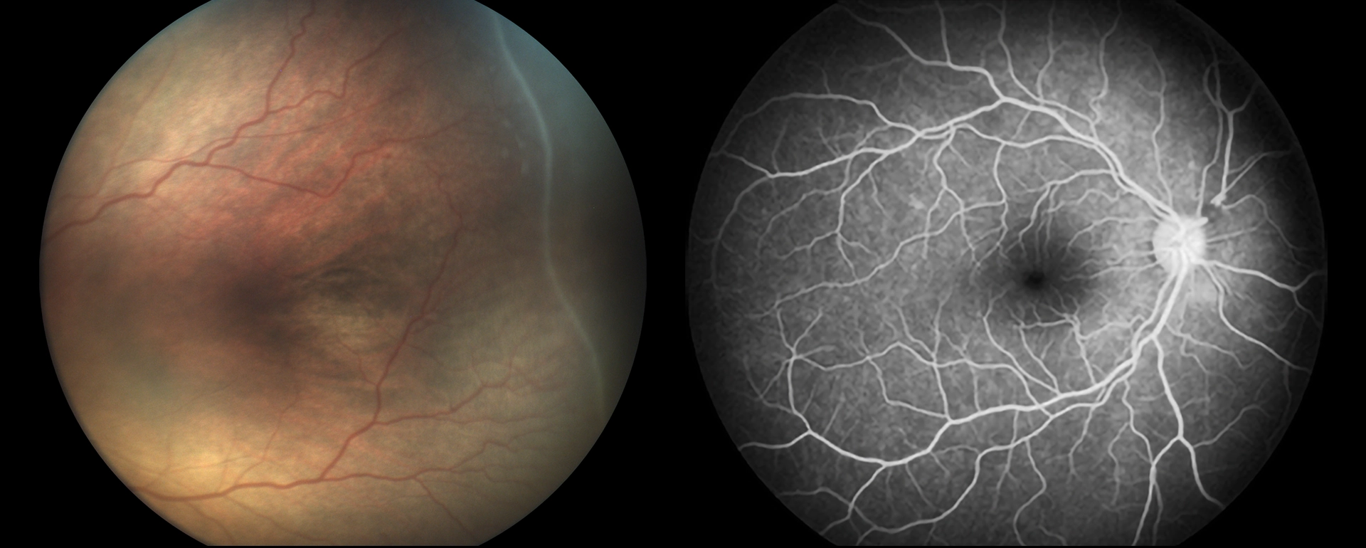 ICON™ GO Becomes the World's Only Portable FDA-Cleared Retinal Imaging System with Expanded ...